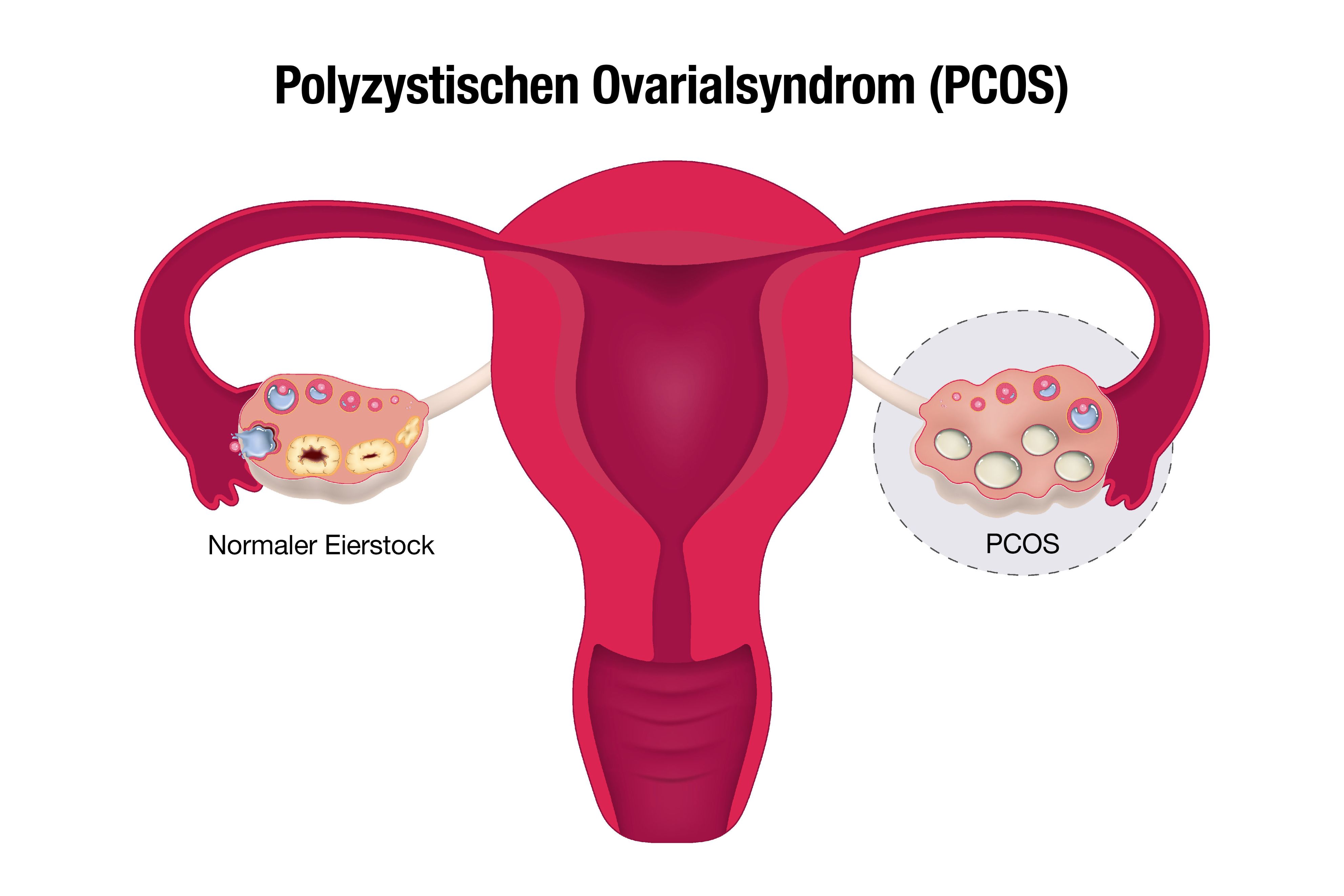 Das PCO-Syndrom kurz erklärt | Migros iMpuls