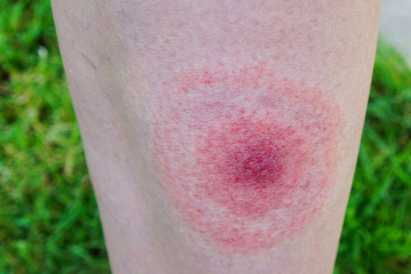 Was tun bei einem Zeckenbiss? | Migros iMpuls